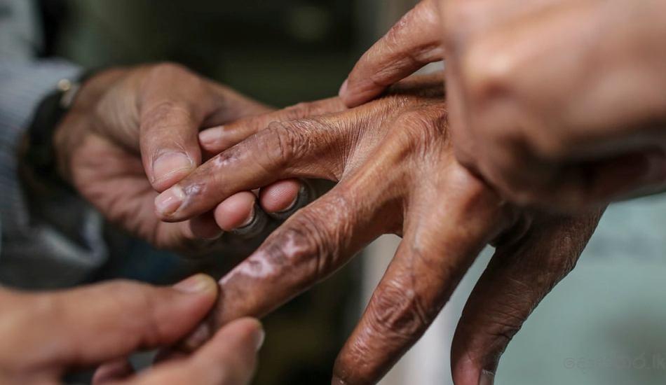 වසරක් තුළ ලාදුරු රෝගීන් 387 ක් - Life Traveler